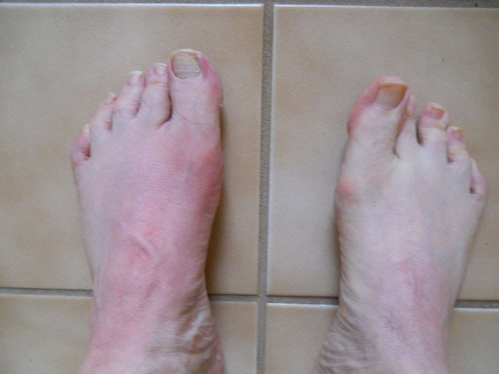Gout: 10 Symptoms of Gout